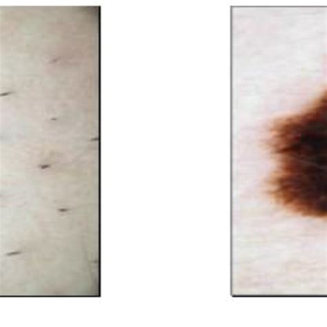 Sample Dermoscopic Images A Benign Skin Lesion And B Malignant Download Scientific Diagram
