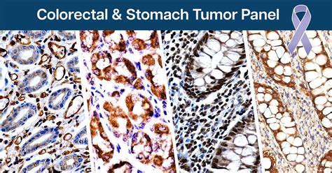 Biogenex Cancerawareness Earlydetection Biomarkers Colorectalcancer Stomachcancer Biogenex