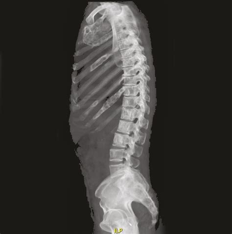 Dysplasie Fibreuse Polyostotique La Revue Du Praticien