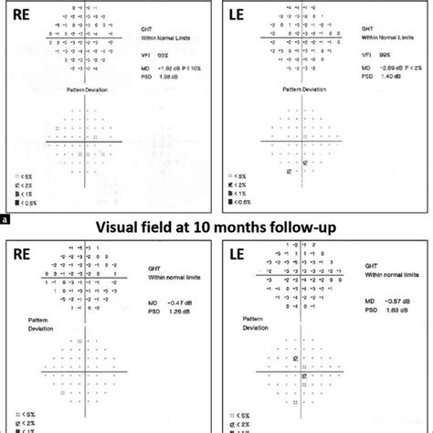 Hvf Report For Both Eyes At Baseline A And Follow Up After 10 Months