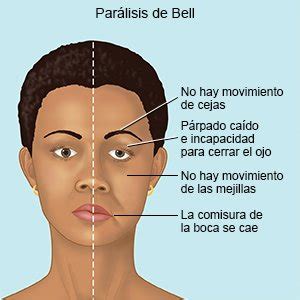 Parálisis De Bell Lo Que Necesita Saber