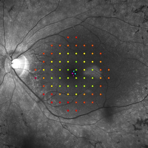 Icare Maia Microperimeter Icare