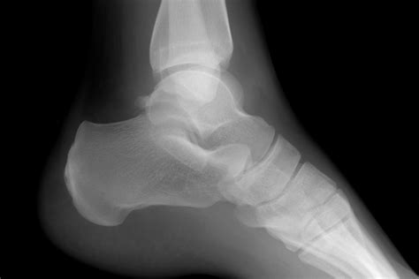Thankfulness And A Broken Ankle JeffRandleman
