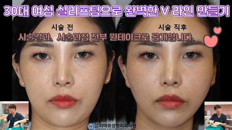 실리프팅 30대 여성 실리프팅 시술 과정 및 결과 전부 공개합니다 Youtube