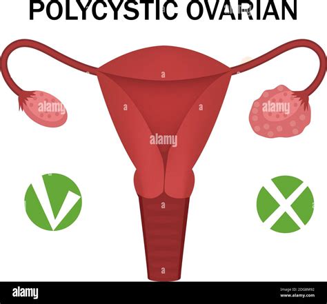 Healthy Ovaries