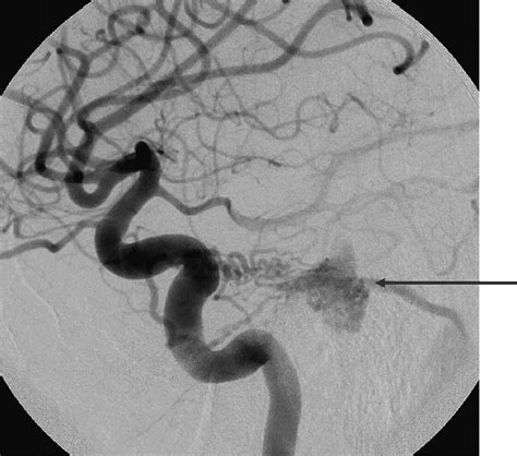 Smad4 Mutation And The Combined Syndrome Of Juvenile Polyposis Syndrome And Hereditary