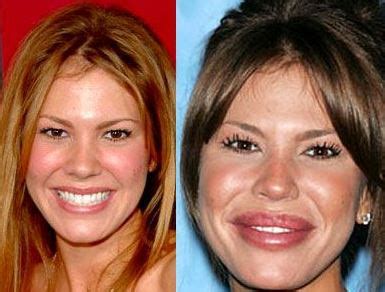 Botched Jobs 14 Cases That Will Make You Think Twice About Plastic