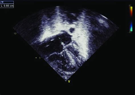 Echocardiogram Shows Atrial Septal Defect Patent Ductus Arteriosus