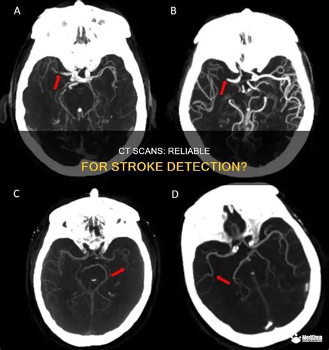 Ct Scans Reliable For Stroke Detection Medshun Ct Scans Reliable For Stroke Detection Medshun