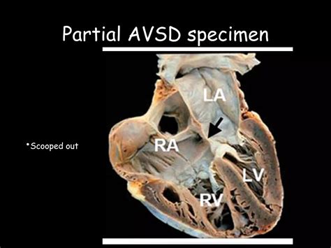 Atrioventricular Septal Defect Pptx Heart And Cardiovascular Diseases Diseases And Conditions