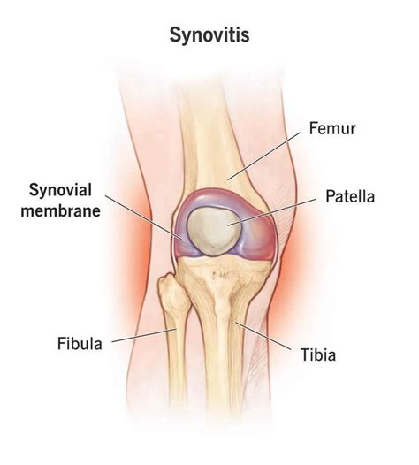 Synovitis Synovial Inflammation Symptoms And Causes Wockr