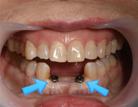 아래 앞니 임플란트 후기 및 전후 사진 기록 네이버 블로그