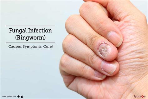 Fungal Infection Ringworm Causes Symptoms Cure By Dr Ramya M N