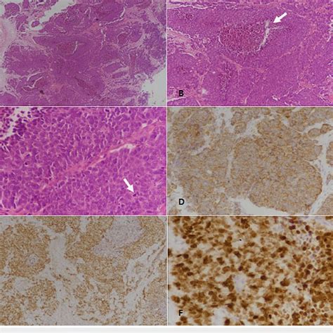 Neuroendocrine Tumor Grade 1 Of Primary Gastrointestinal Tract Origin Download Scientific