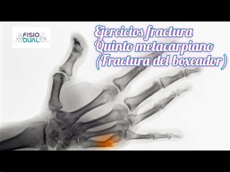 Rehabilitación Efectiva De La Fractura Del 5 Metacarpiano Guía