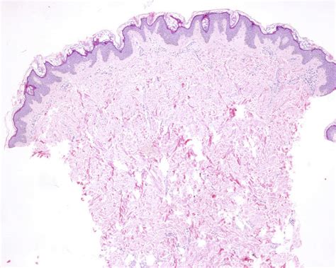 Large Hyperpigmented Macule On The Leg Of An Adolescent Girl Actas