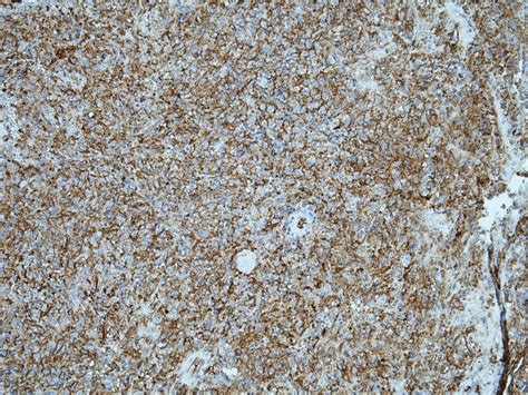 10× Diffuse Staining With Cd31 Marker In The Neoplasm Download Scientific Diagram