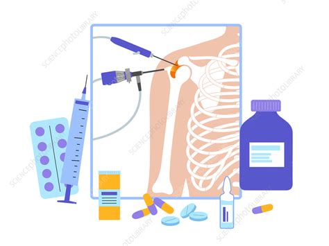 Shoulder Arthroscopy Procedure Illustration Stock Image F0428262