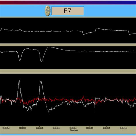 Result Of The Recursive Least Squares Noise Canceling Adaptive Filter Download Scientific