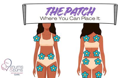 Evra® Patch South Africa Side Effects And Cost Guide