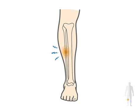 What Is A Proximal Fibula Fracture And How Is It Treatedupswing Health