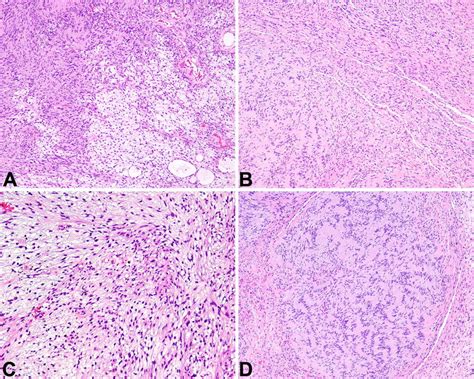 Vestibular Schwannoma Pathology