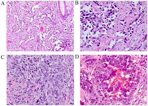 Angiosarcoma Histology
