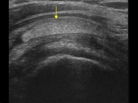 Musculoskeletal Joints And Tendons 6 1 Shoulder Case 6 1 18 Bursa Calcific Bursitis