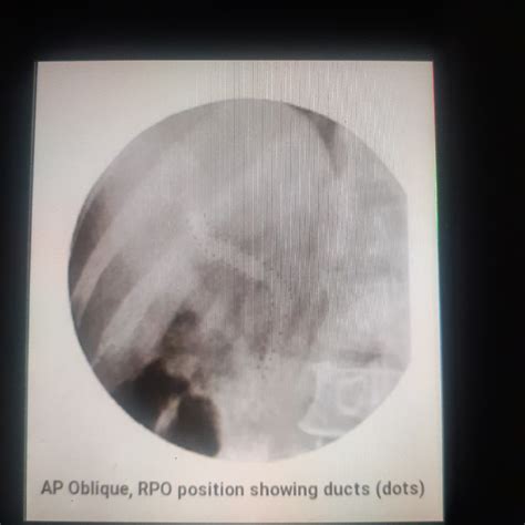 Intravenous Cholangiogram