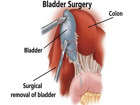 Bladder Surgery Baberahma
