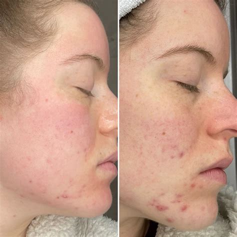 Started Epiduo Forte Just Under A Week Ago Seems To Be Working