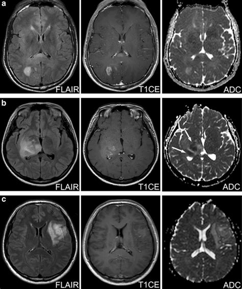 Representative Cases Of Anaplastic Glioma Showing Association Of RRSs Download Scientific