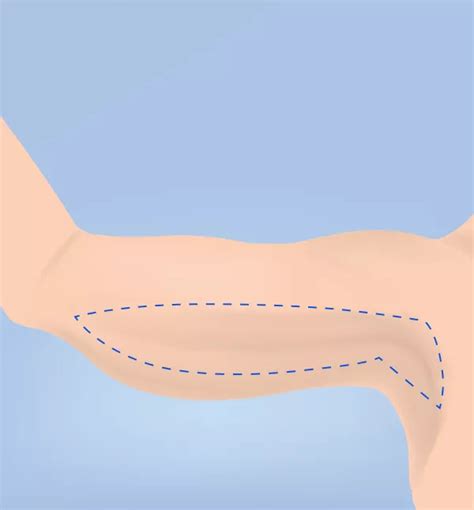 Brachioplasty In Mexico Dr Manuel Sevillano Plastic Surgeon