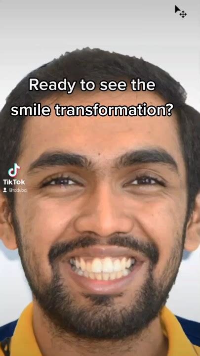 Video Dr Rajat Dutta On Linkedin Invisalign Braces Damon