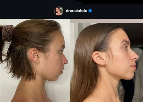 Jaw Dysfunction And Neuro Sensitive Dysautonomia Stronger Gum