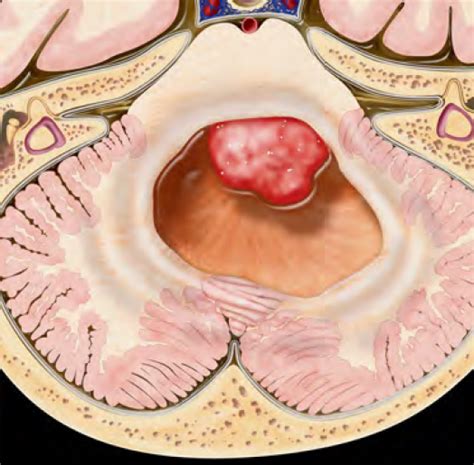 Posterior Fossa Tumors Pfsol Surgery In Bangladesh