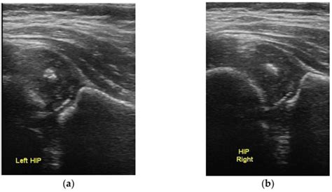 Concentric Circles A New Ultrasonographic Sign For The Diagnosis Of