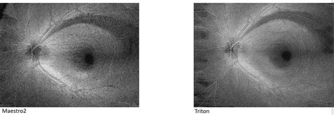 Glaucoma Detection Using Retinal Nerve Fiber Layer Optical Texture Analysis Review Of