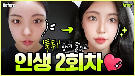 튀어나온 광대 쏙 넣고 핫girl 되기 궁금하면 클릭 성형전후 광대축소 Youtube