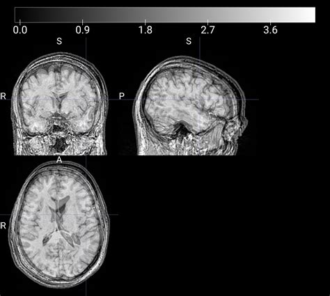 issue with longitudinal t1 template · issue 647 · pennlinc qsiprep