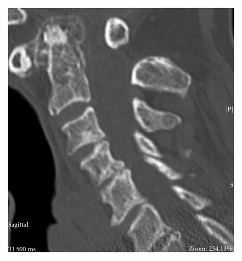 Sagittal Ct Scan Reconstruction Of A Patient Showing Odontoid Pannus Download Scientific