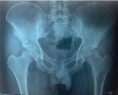 Plain X Ray Of The Left Hip Joint Shows Increased Medial Joint Space