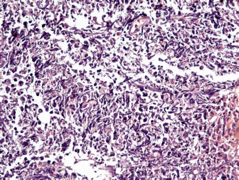 On High Power Diffuse Infiltration Of Mucosa By Atypical Lymphoid Download Scientific Diagram