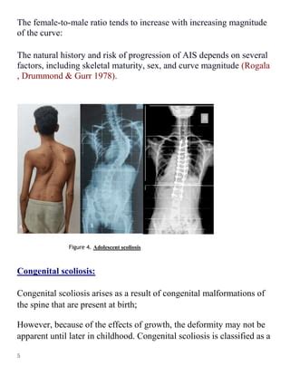 SCOLIOSIS Presentation On SCOLIOSIS Doc Physical Therapy Wellness