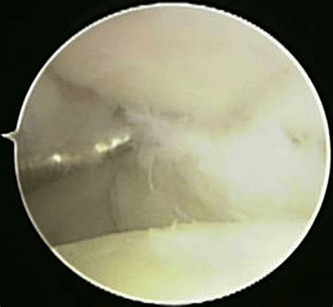 Mcp Inflammatory Arthropathy Postoperatively Download Scientific Diagram