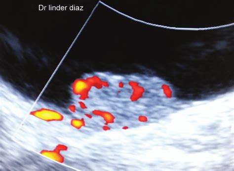 Adnexal Mass Classified As Gi Rads 4 There Were Two Suspicious