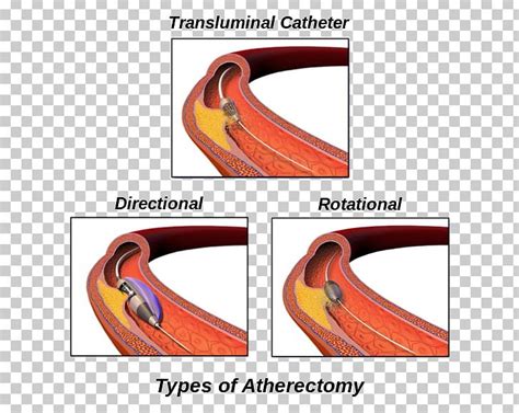 Atherectomy Peripheral Artery Disease Surgery Cleveland Clinic Png Clipart Arteriosclerosis