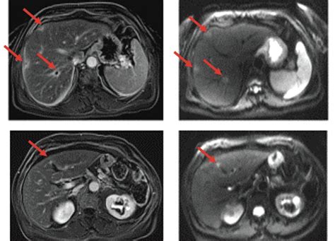 Portal Vein Embolization Plus Hepatic Vein Embolization For Hepatic