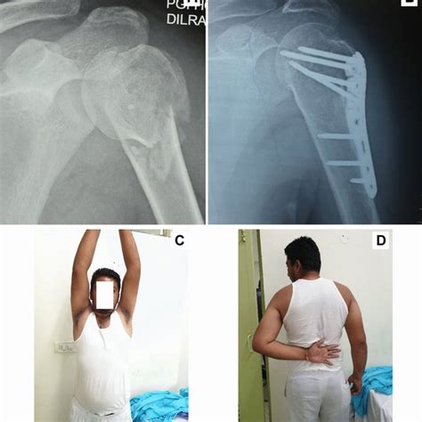 proximal humerus fracture operated with deltopectoral approach dp