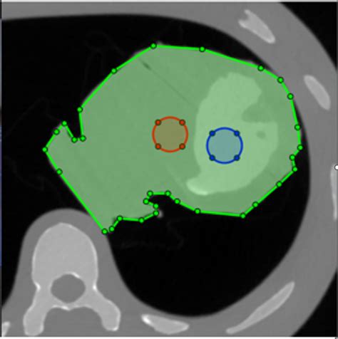 Placement Of The Two Rois For Contrast To Noise Ratio Cnr